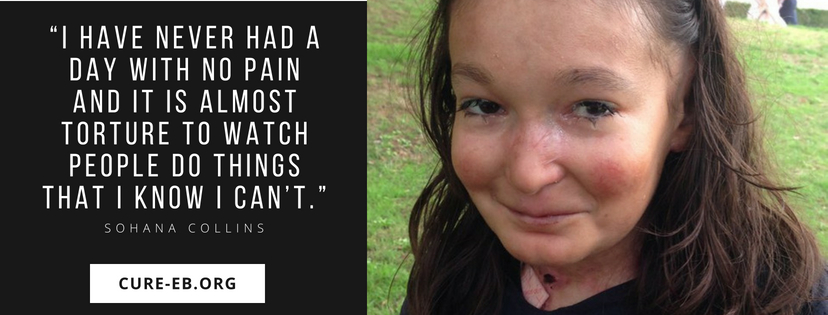 4 Things I Wish People Knew About Parenting an EB Child – Silvia's Kingdom